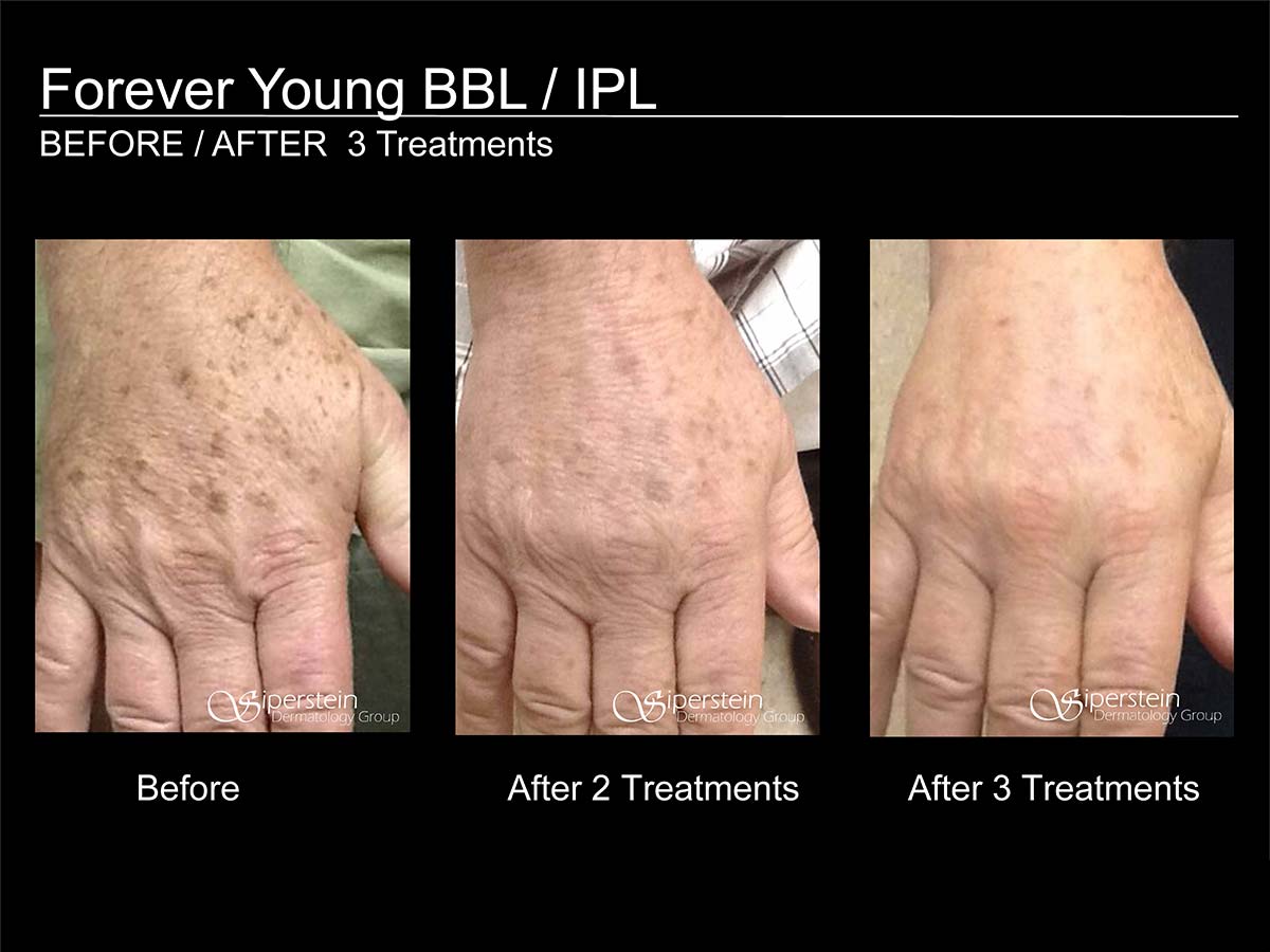 Forever Young BBL / IPL / Photofacial - Siperstein Dermatology Group Forever Young BBL / IPL / Photofacial - Siperstein Dermatology Group