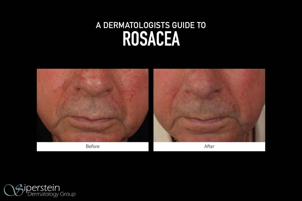 What Triggers Rosacea And How Is It Treated?