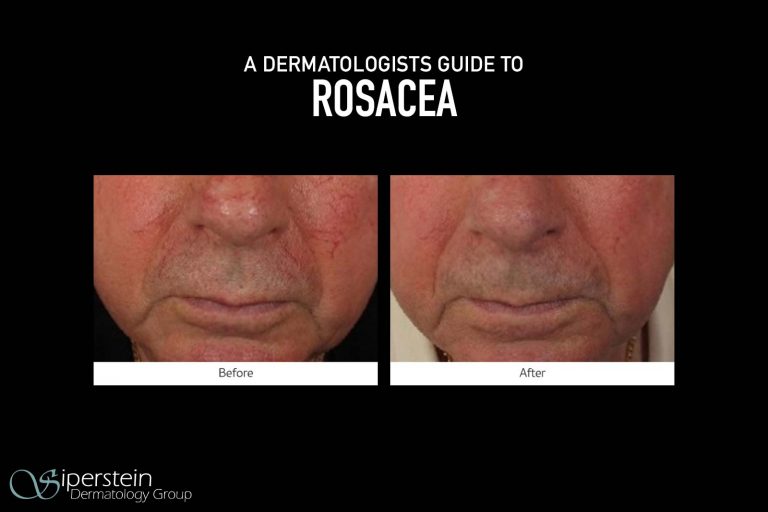 What Triggers Rosacea And How Is It Treated?