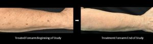Dr. Siperstein Studies New Treatment for Forearm Bruising - Siperstein ...