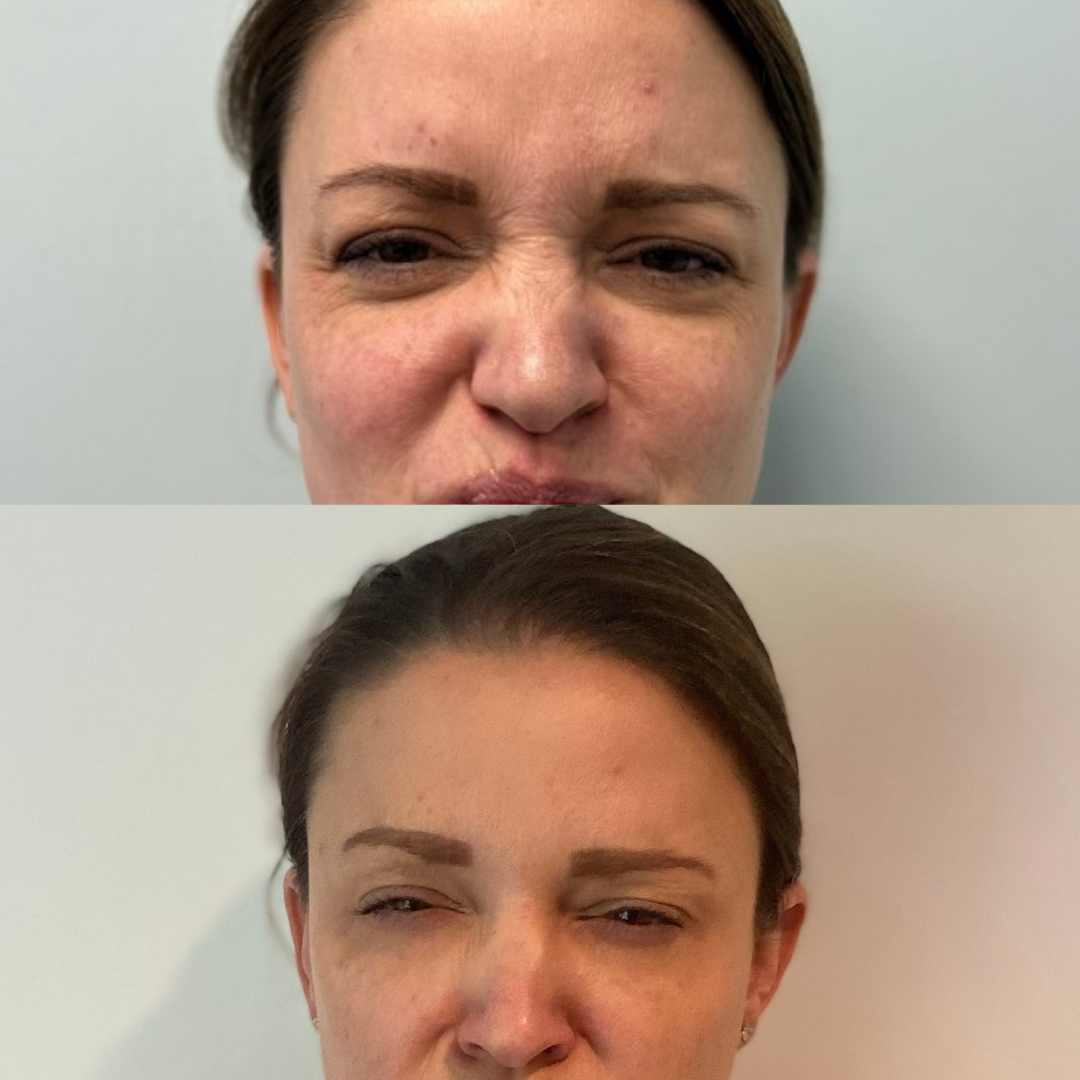 Five Surprising Places to Inject Botox - Siperstein Dermatology Group