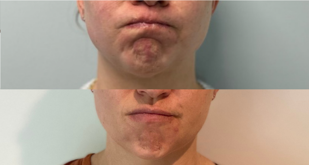 Five Surprising Places to Inject Botox - Siperstein Dermatology Group