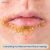What to Know About Impetigo Skin Infection