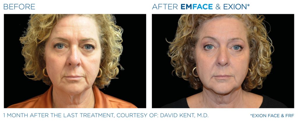 Emface Facial Treatment | Lift & Tone Without Surgery