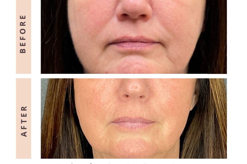 Laser Resurfacing - Siperstein Dermatology Group
